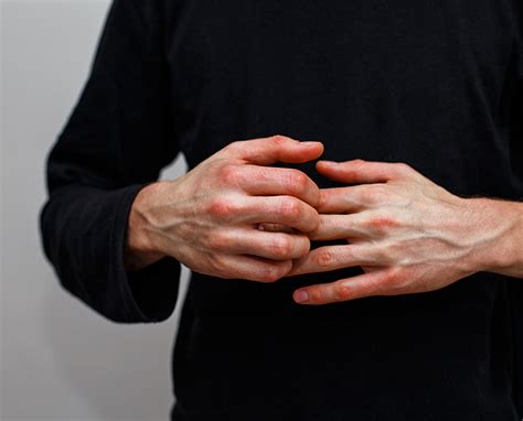Disidrose sintomas e tratamentos Fundação Eczema