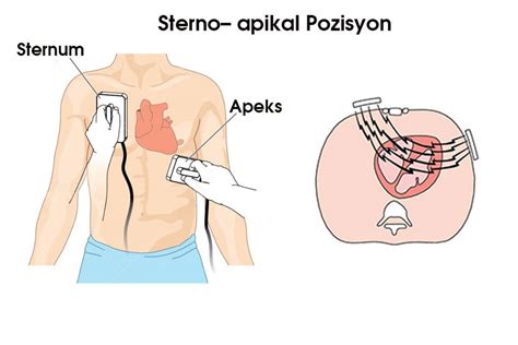 Ventriküler Fibrilasyon VF Acil Çalışanları