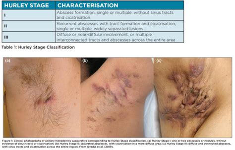 An Overview Of Hidradenitis Suppurativa The Medical Republic