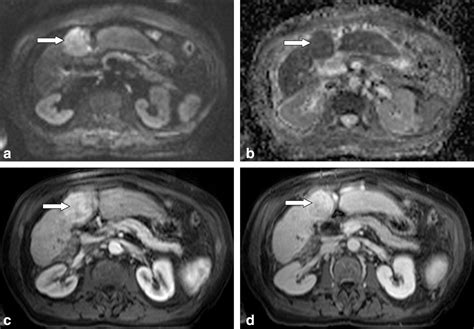 Utility Of Diffusionweighted MRI In Distinguishing Benign And