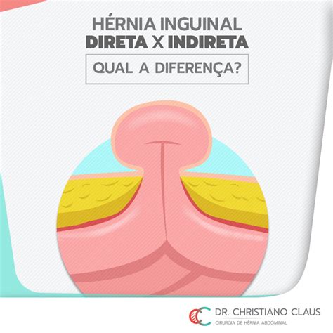 Inguinal Hernias Direct And Indirect Inguinal Hernias