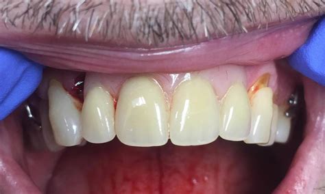 Front Partial Dentures
