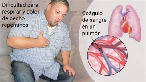 Sabes qué es el tromboembolismo pulmonar DIARIO ROATÁN