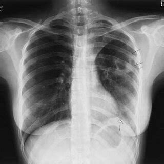 Chest Radiograph Posteroanterior View Showing Cavitary Lesions In A