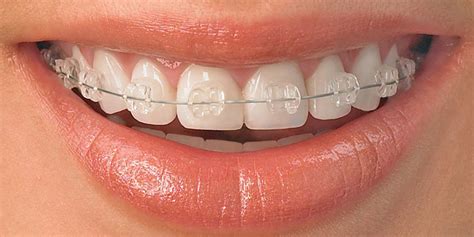 Ortodonti Diş Teli Fiyatları Ortodonti Uzmanı Ortodontist