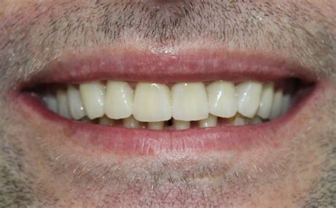 Pose d un implant dentaire 3 étapes pour comprendre facilement