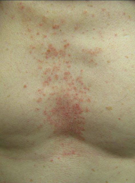 Dermdx Patchy Rash On Chest Clinical Advisor
