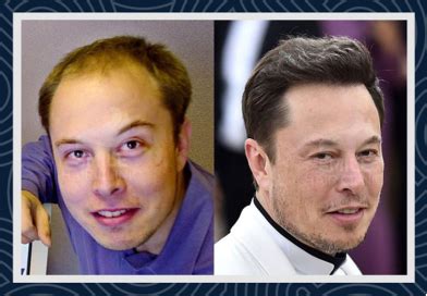 Elon Musk Hair Transplant 2023 Smile Hair Clinic