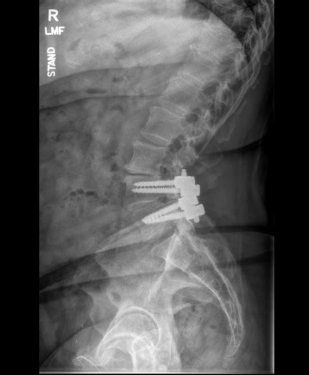Sublaminar Decompression For Lumbar Stenosis With Degenerative