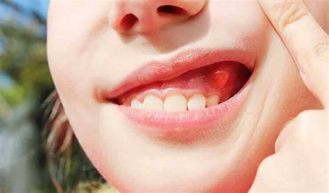 Flemón dental Clínica Dental Ramis Gandía