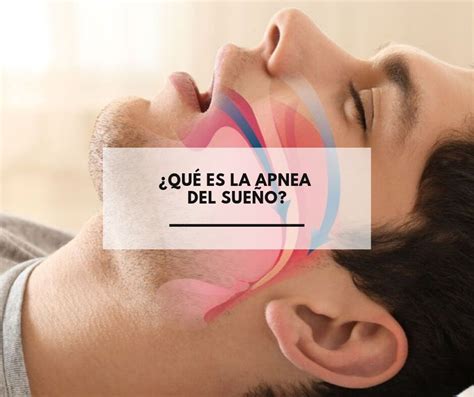 Cuales Son Las Consecuencias De La Apnea Del Sue O Cl Nica Dental