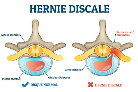 Hernie discale calcifiée ou molle diagnostic et traitements