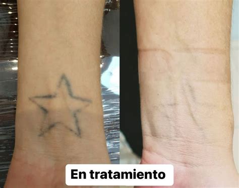 Remoción de tatuajes micropigmentación con láser LA CROIX URUGUAY