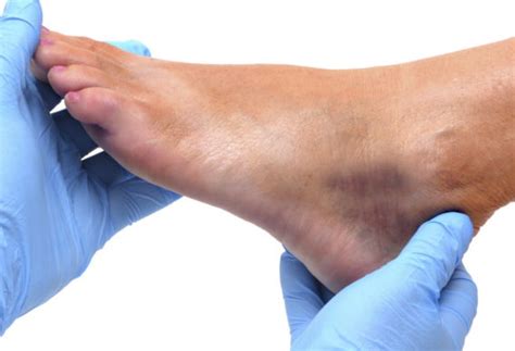Causas Y Remedios Para Los Pies Hinchados Salud Envidiable