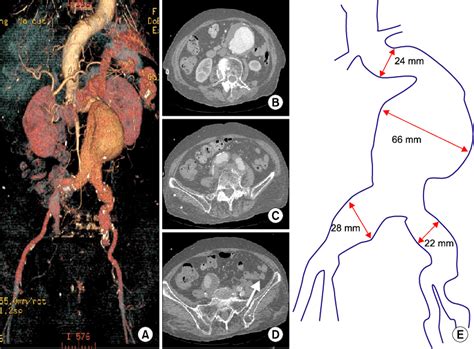Preoperative Computed Tomography Of Abdominal Aortic Aneurysm AAA