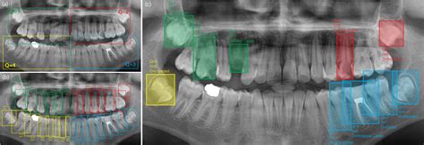 Figure From Dentex An Abnormal Tooth Detection With Dental
