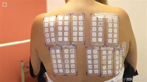 Pruebas de Parche qué es síntomas y tratamiento Top Doctors