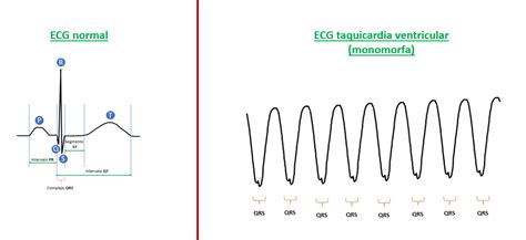 Electrocardiograma de una taquicardia ventricular Explicación