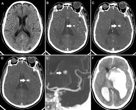 Intracerebral Hemorrhage Mri