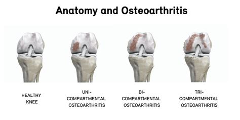 Tricompartmental Osteoarthritis Treatment Carrothers Orthopaedics