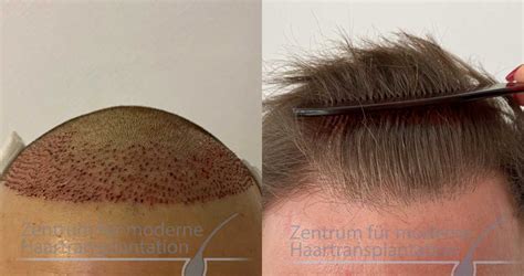 Haartransplantation 11 Tipps vom führenden Experten