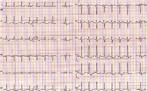 ECG During Warm Up Exercise Stress Test With Early ST Segment