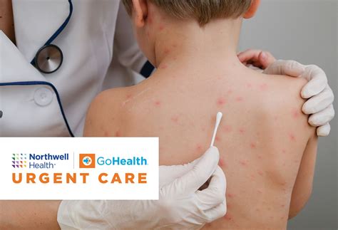 Chicken Pox How Did It Get Its Name Outlet Dakora Co