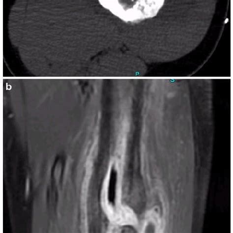 CT Scan Axial View A And T2 Weighted MRI Coronal View B