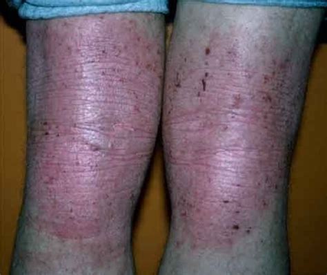 Common Secondary Skin Lesions Flashcards Quizlet