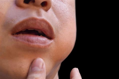 Parotitis Parotid Gland Swelling Causes Symptoms Treatment