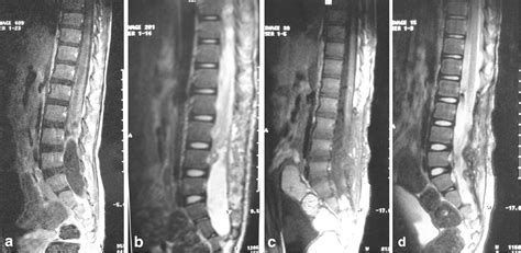 Figure 1 From Infected Lumbar Dermoid Cyst Presenting With Tetraparesis Secondary To Holocord
