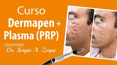 CURSO DE DERMAPEN PLASMA RICO EN PLAQUETAS YouTube