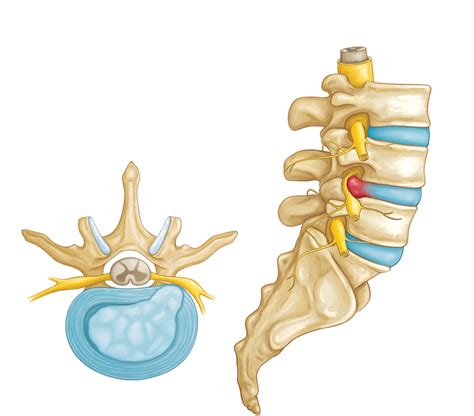 How To Tell If You Have A Herniated Disk Orthopedic Sports Medicine