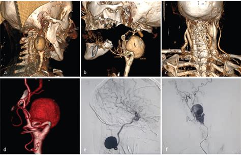 Extracranial Internal Carotid Artery Aneurysm Treated With High Flow