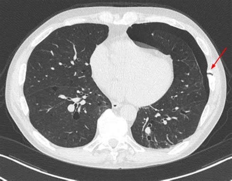 Pleural Disease Flashcards Quizlet