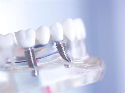 Dentadura postiza vs Implantes dentales cuál es la mejor opción para