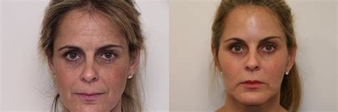 Facial Rejuvenation Before And After Pictures Case 17 Atlanta