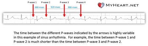 Bradycardia Sinus Rhythm With Sinus Arrhythmia Flash Sales Jkuat