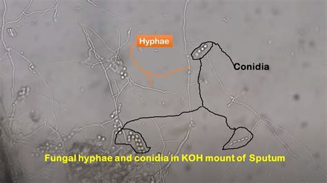 Fungal Hyphae And Conidia In KOH Mount Of Sputum YouTube