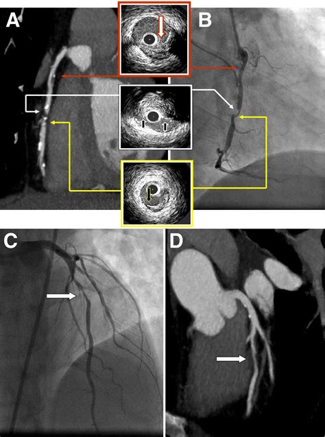 Computed Tomographic Angiographic Morphology Of Invasively Proven