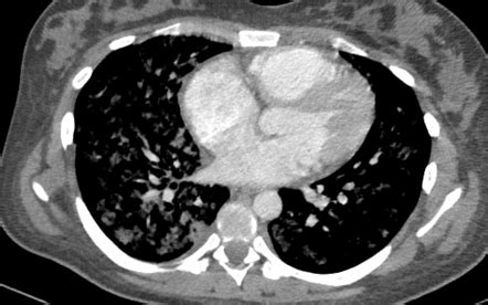 Diffuse Alveolar Hemorrhage Image Radiopaedia Org