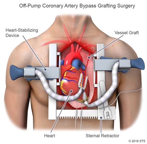 Mics Cabg Minimally Invasive Coronary Bypass
