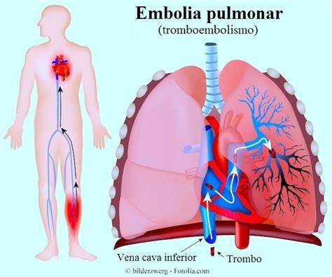 Embolia Pulmonar Diagnostico Diferencial Tratamiento Complicaciones