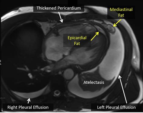 A Rare Case Of Sarcoidosis Induced Polyserositis And Steroid Induced