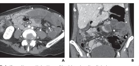Small Bowel Obstruction From Adhesive Bands And Matted Adhesions Ct