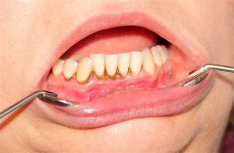 Cómo quitar el sarro de los dientes Clínica dental Soria Vizcaíno