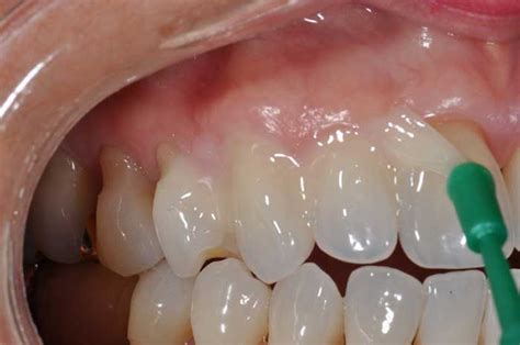 The Importance Of Fluoride To Maintain Good Oral Health