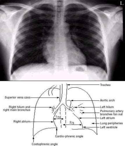 Chest X Ray Flashcards Quizlet