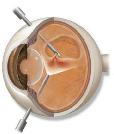 Qué es la Vitrectomía Cirugía ocular Clínica VISIONKER