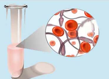 Hemospermia sangre en el semen Urología Peruana Dr Susaníbar